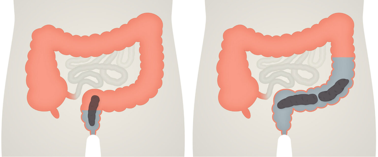 Rectal Irrigation Decision Guide - Qufora