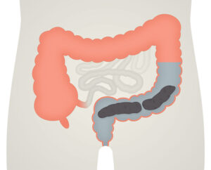 What is rectal irrigation? - Qufora